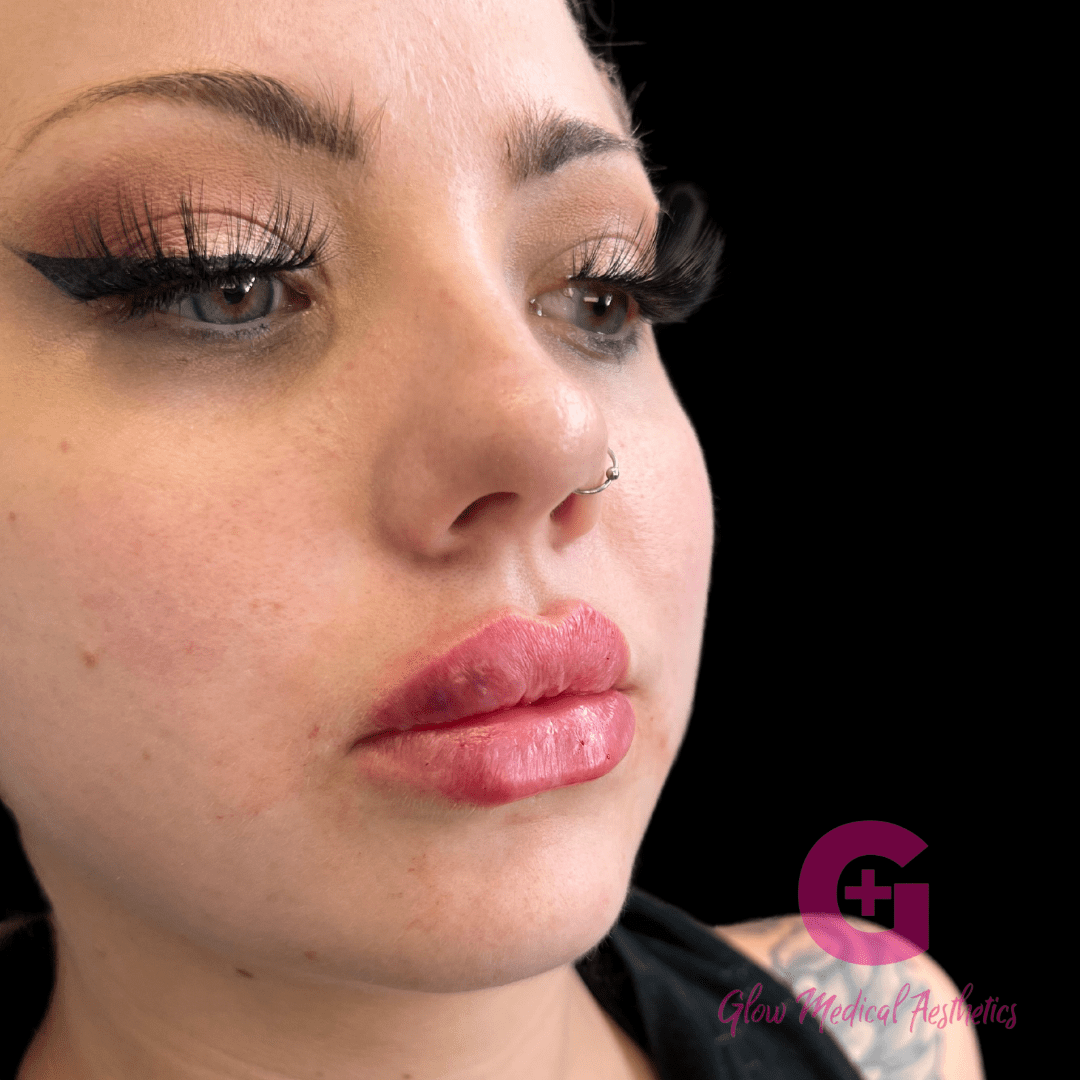 Lip Enhancement | Glow Medical Aesthetics