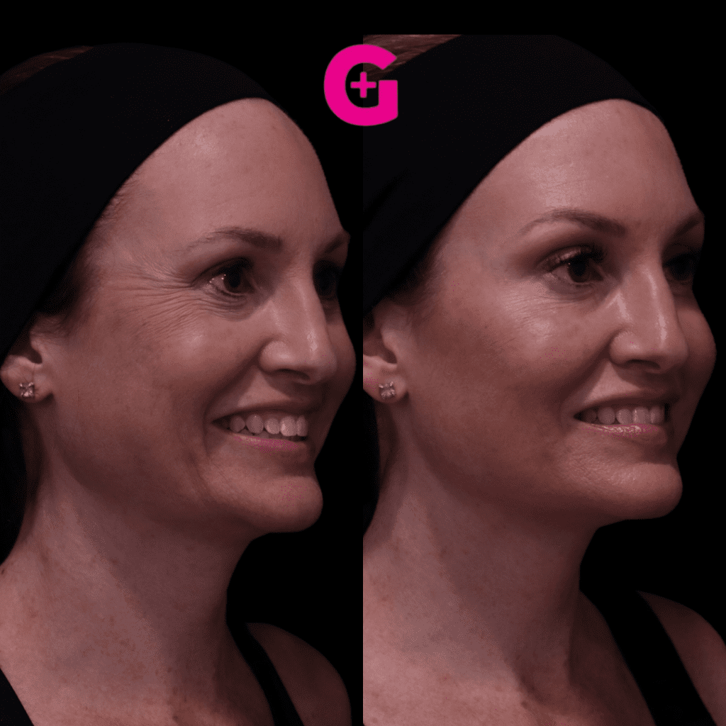 Before and After - Glow Medical Aesthetics
