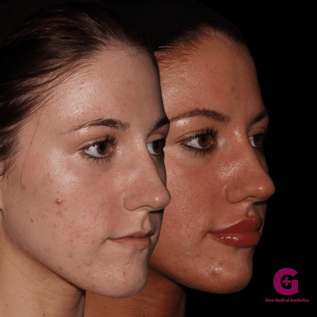Lip Enhancement | Glow Medical Aesthetics