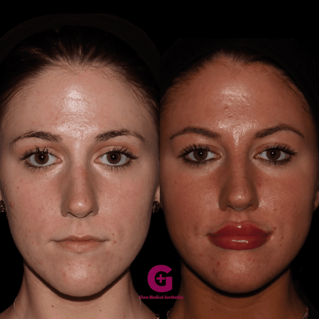 Lip Enhancement | Glow Medical Aesthetics