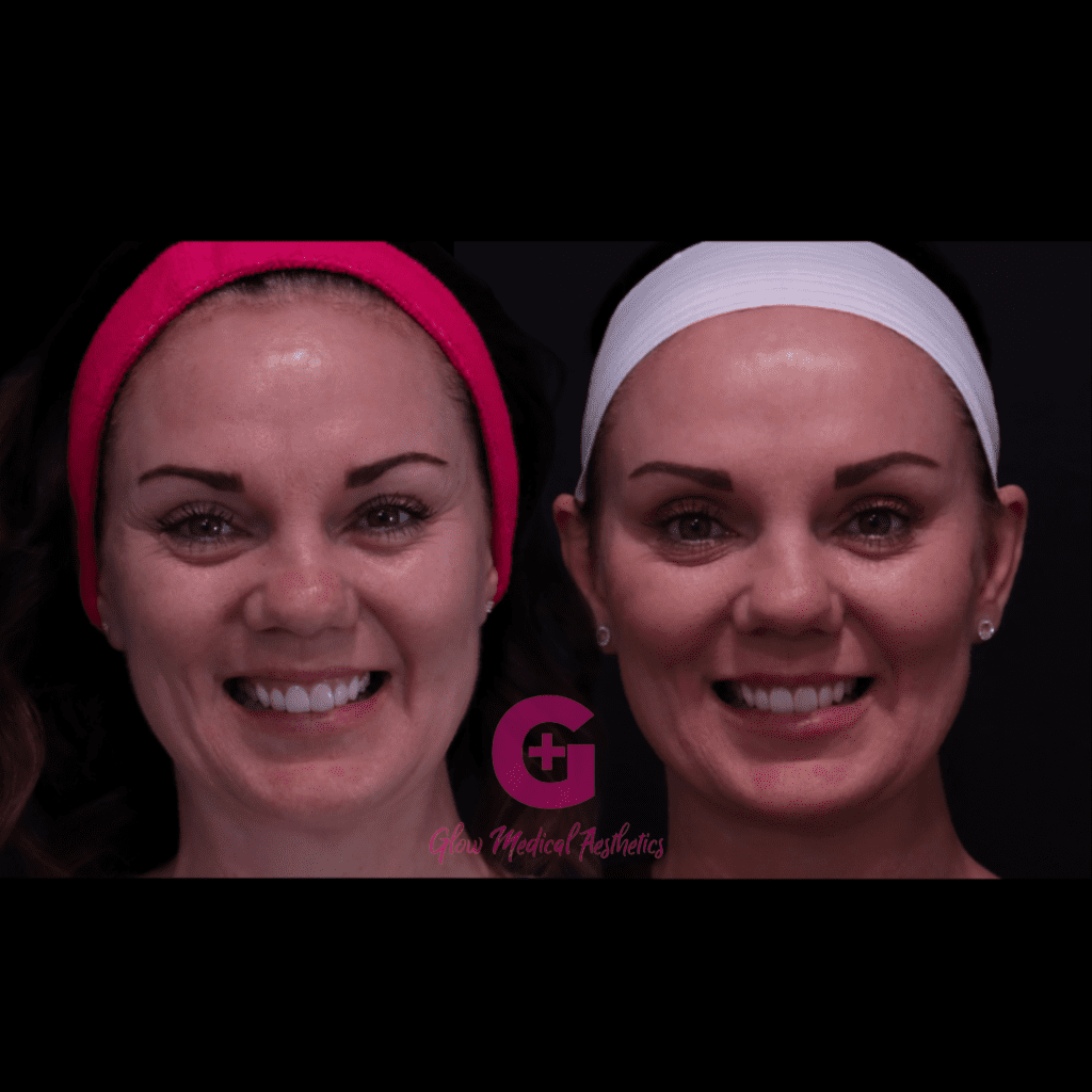 Before and After - Glow Medical Aesthetics