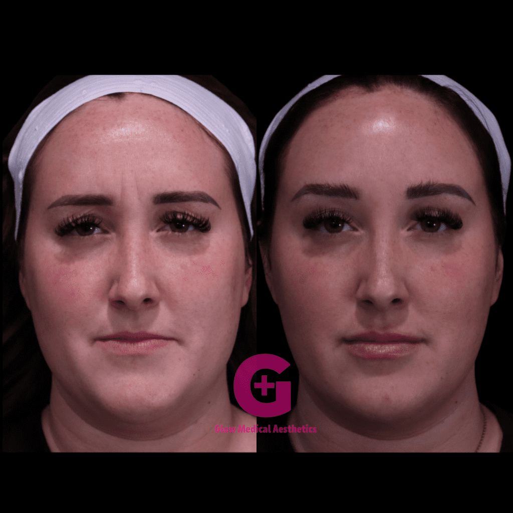 Before and After - Glow Medical Aesthetics
